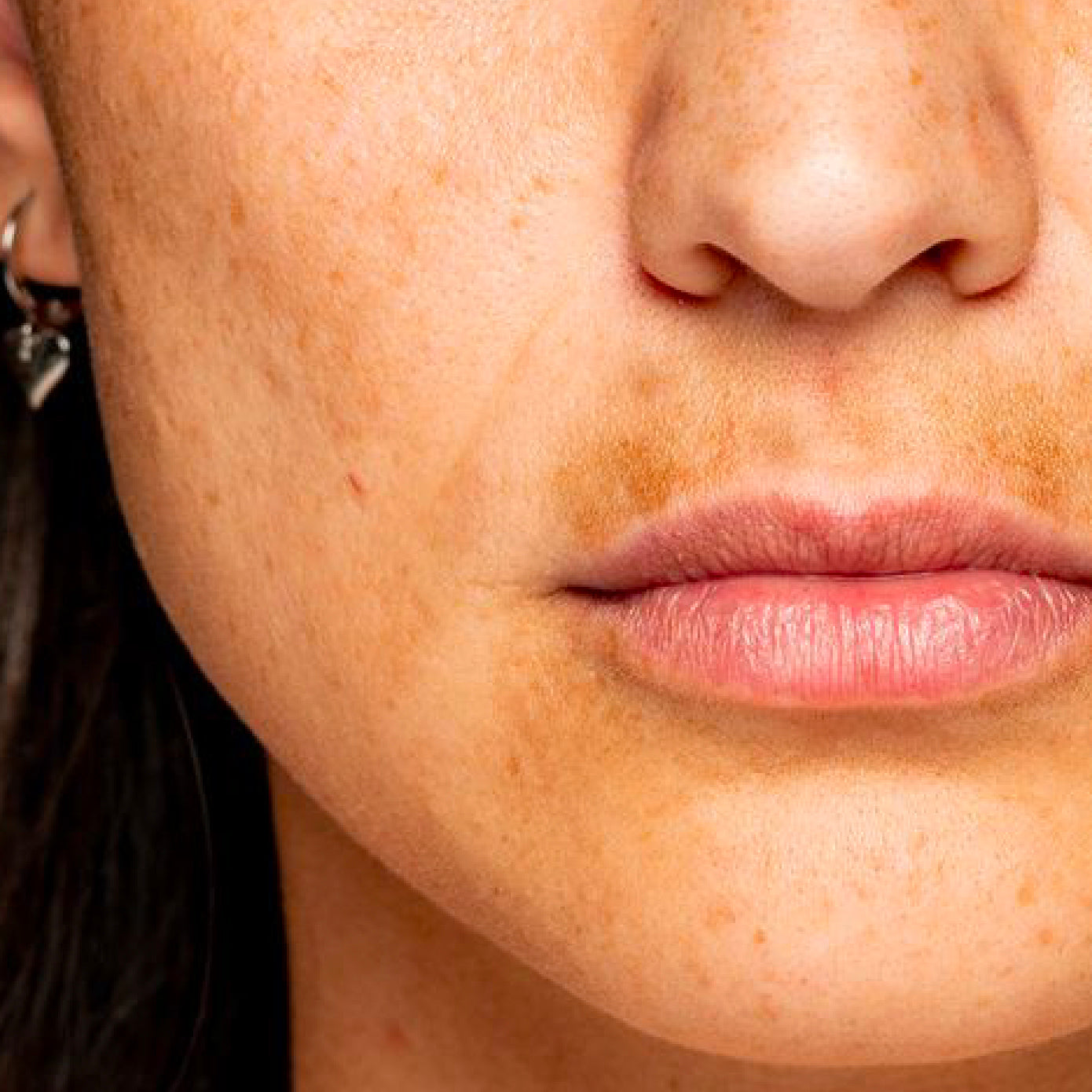 Acne & Breakouts – Kohom Organics